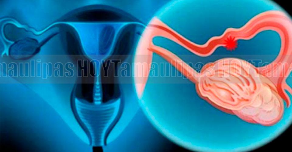 Hoy Tamaulipas - ¿Conoces los sintomas del cancer cervicouterino