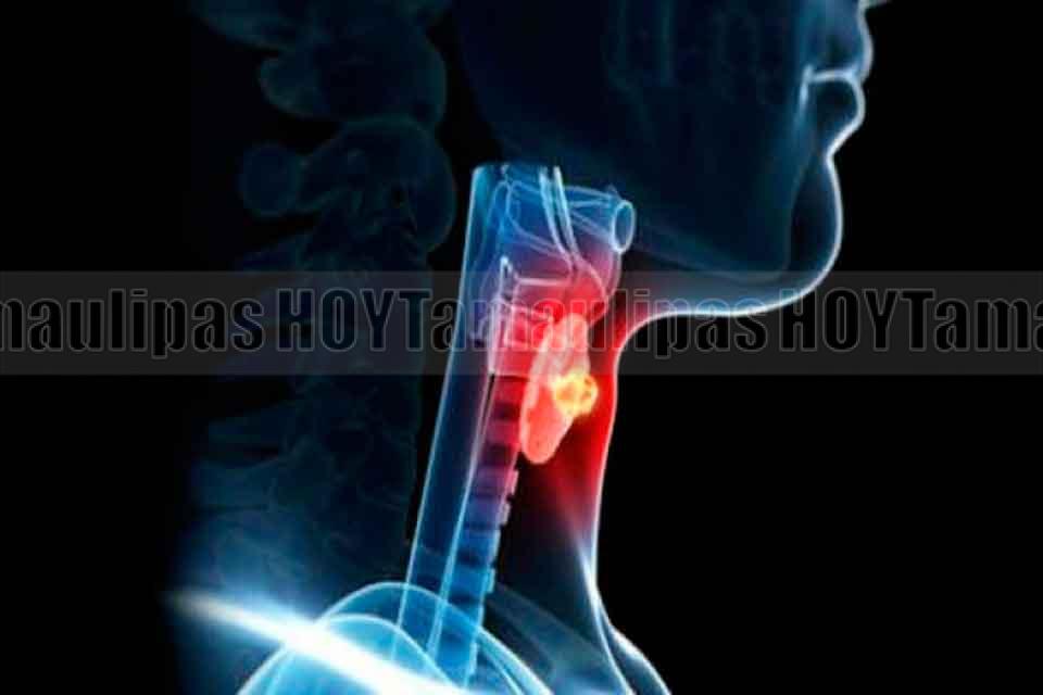 Hoy Tamaulipas - IMSS Jalisco trata cancer de laringe con equipo de ...