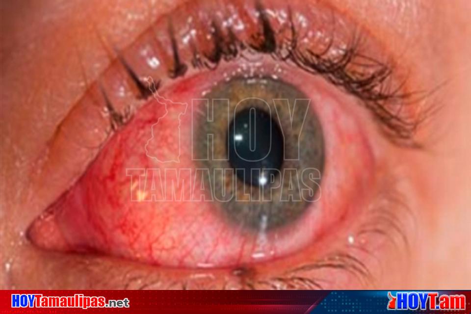 Hoy Tamaulipas Registra Tamaulipas 16 Mil Casos De Conjuntivitis
