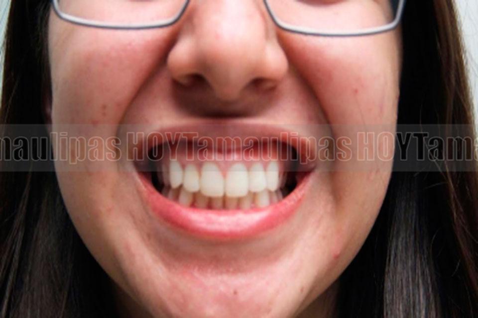 Hoy Tamaulipas - Dientes daniados podrian ser factor de riesgo para ...