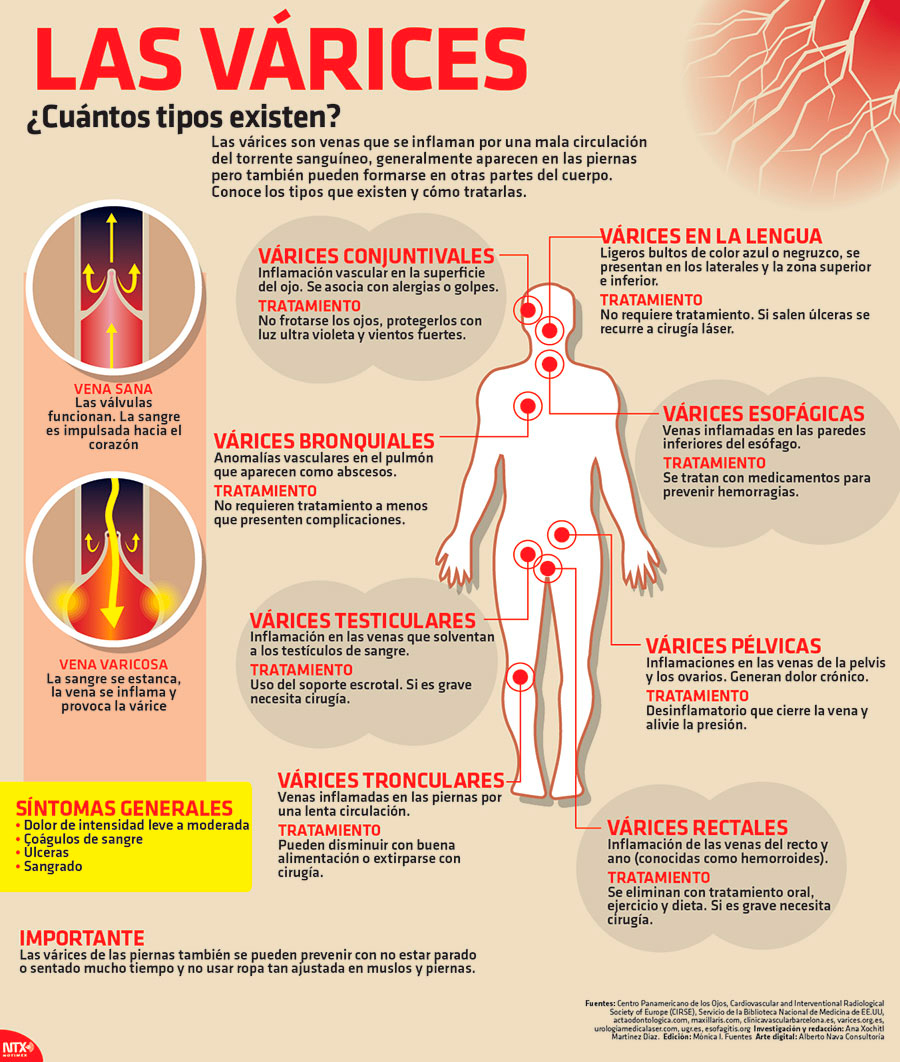 Las várices ¿Cuántos tipos existen?