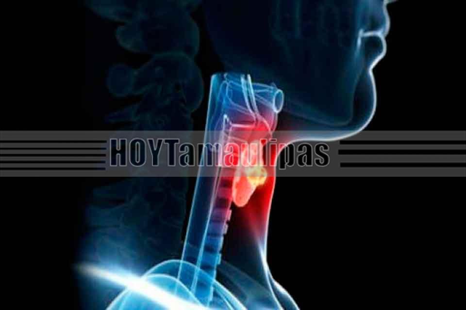 Hoy Tamaulipas - Experto sugiere tratar oportuna y adecuadamente la ...